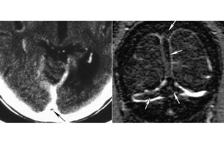 Causes of and Predisposing Factors for Cerebral Venous