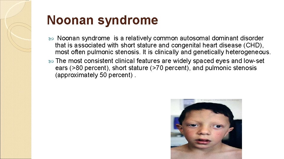 Genetic diseases with primary effects on growth Turner