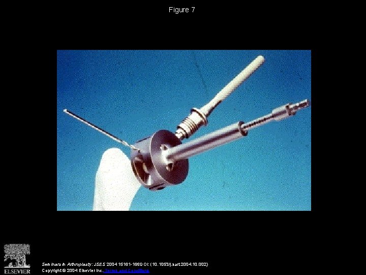 Resurfacing arthroplasty for osteonecrosis Phillip S Ragland MD