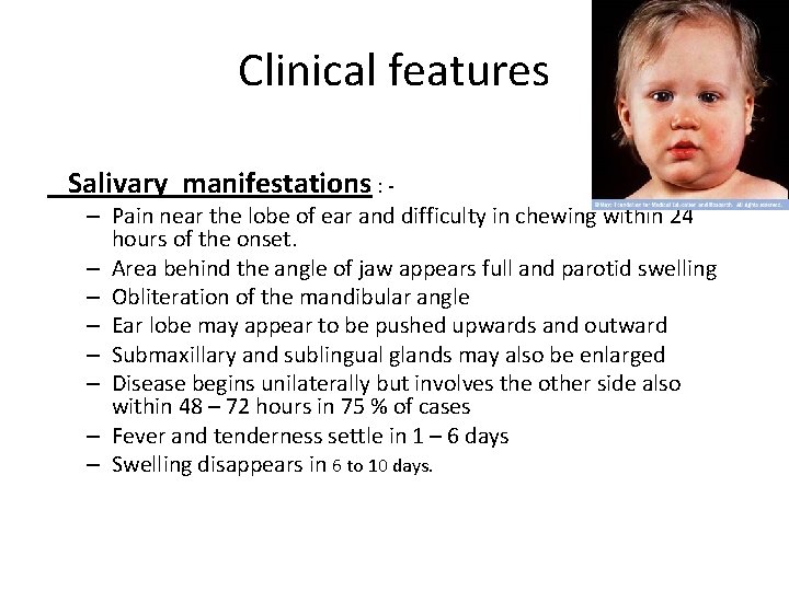 MUMPS Mumps is a self limiting benign viral