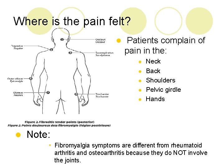 FIBROMYALGIA SYNDROME by Gari Glaser What is Fibromyalgia