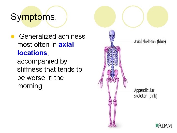 FIBROMYALGIA SYNDROME by Gari Glaser What is Fibromyalgia