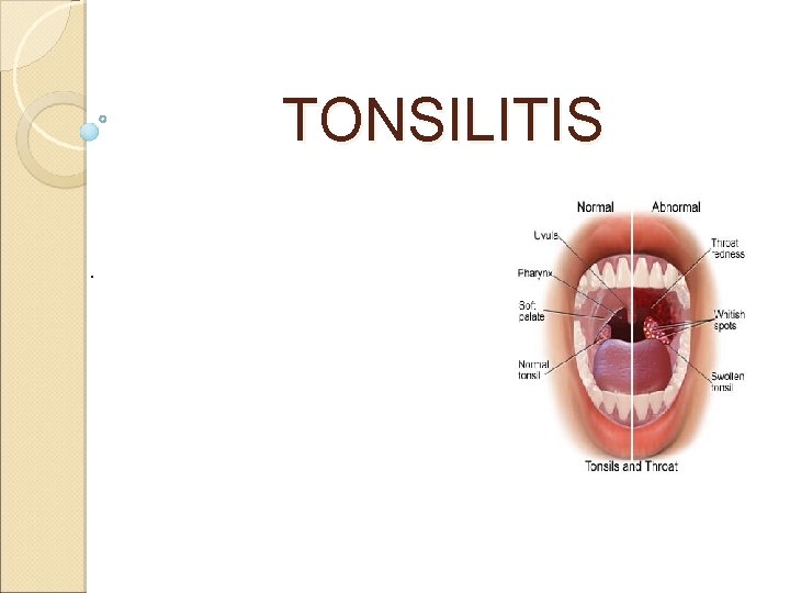 TONSILITIS DEFINITION Tonsillitis is inflammation of the tonsils