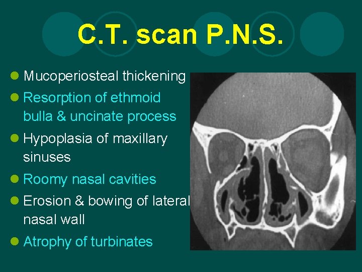 Infective Atrophic Rhinitis Dr Vishal Sharma Acute Infective