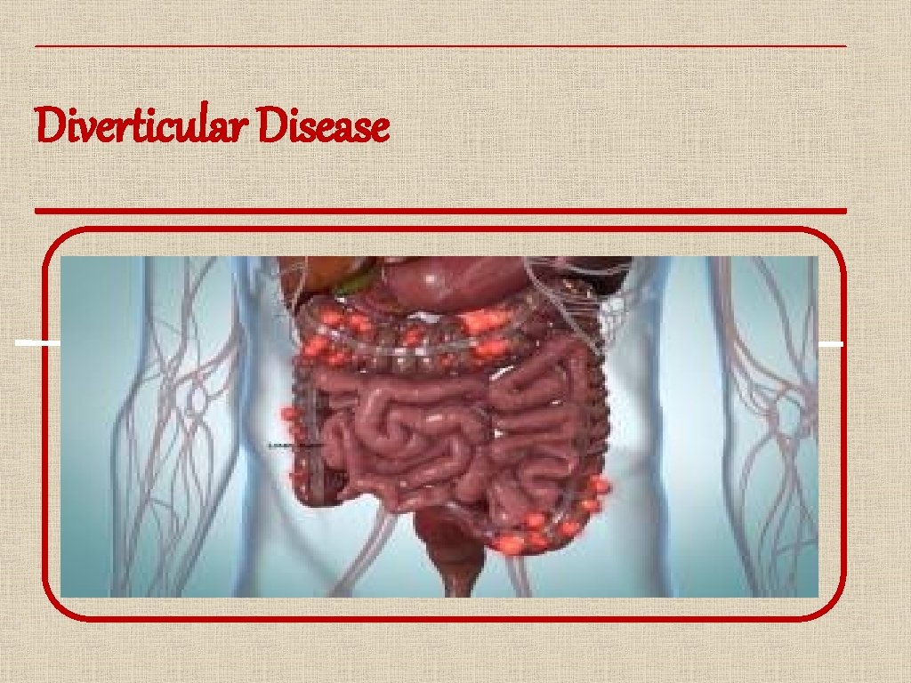 Diverticular Disease Introduction Colonic diverticula are aquired false