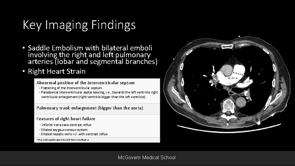 Pulmonary Embolism Kyle Meissner 02012021 RAD 4001 Clinical