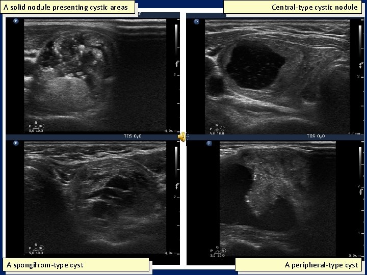 Introduction to the thyroid ultrasound the thyroid nodule