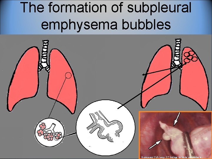 Thoracoscopic treatment of primary spontaneous pneumothorax in children