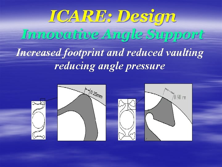 Primary Results of Phakic Injectable Anterior Chamber ICARE