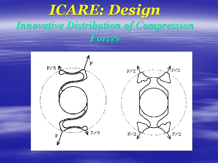 Primary Results of Phakic Injectable Anterior Chamber ICARE