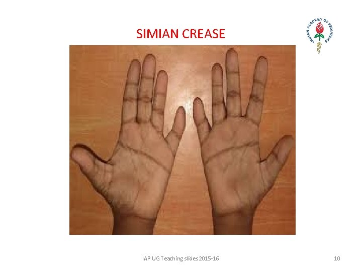 DOWNS SYNDROME IAP UG Teaching slides 2015 16