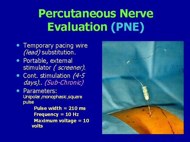 Sacral Nerve Stimulation Critical Update and Literature Review