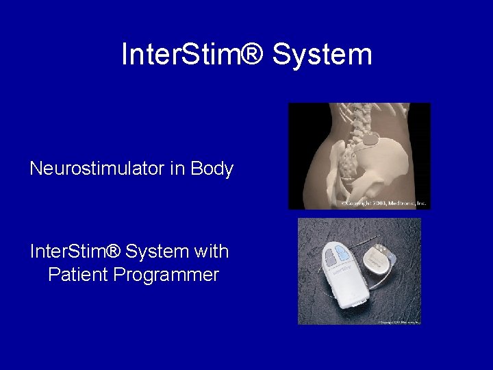 Sacral Nerve Stimulation Critical Update and Literature Review