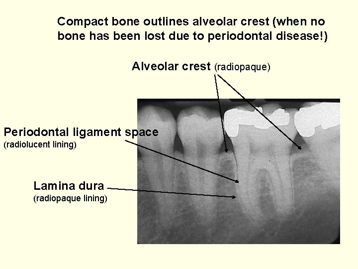BONES And Their Radiographic Appearance 22 Bones make