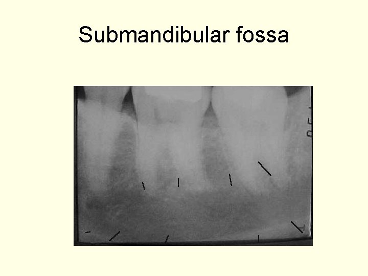 BONES And Their Radiographic Appearance 22 Bones make