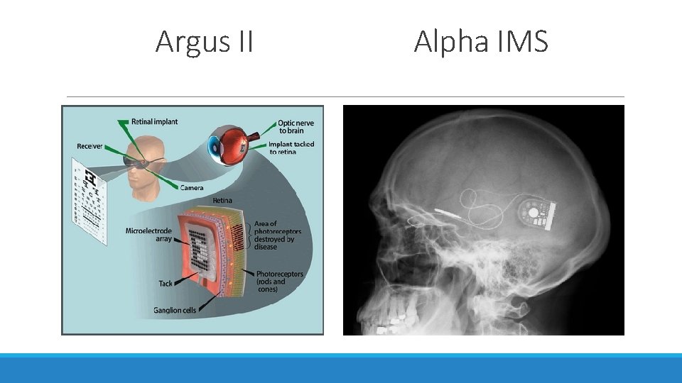 The Bionic Eye JON GOLDBERG BME 181 SECTION