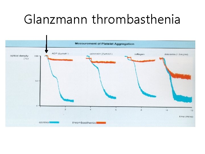 BernardSoulier syndrome Glanzmanns thrombasthenia von Willebrand ...