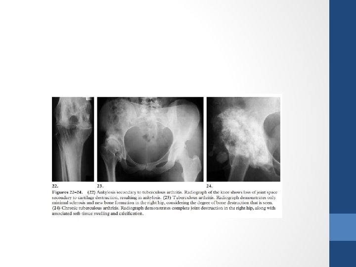 Tuberculous Osteomyelitis and Arthritis Bra Zengin busrazengin 95hotmail