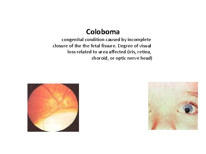 Leukocoria Cataract can be congenital or acquired usually