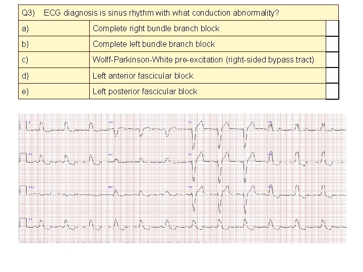 ECG Examples Q1 What is the rhythm in