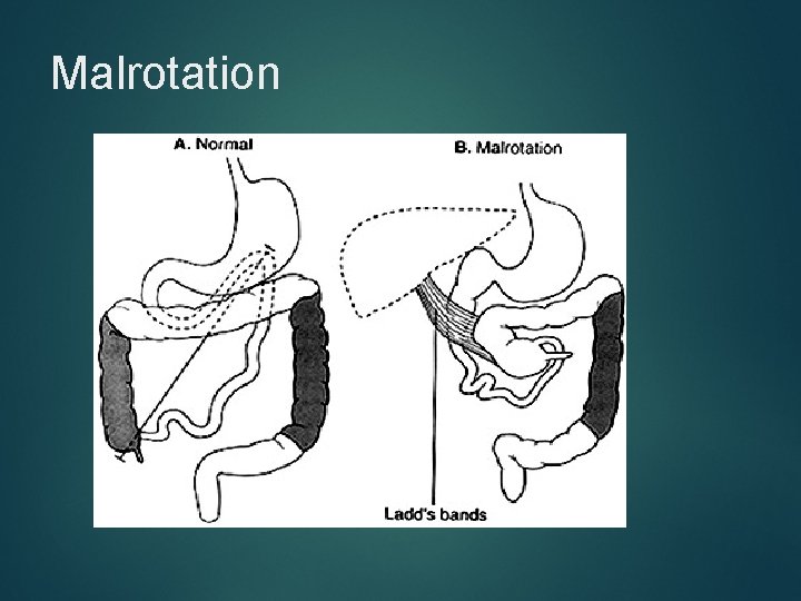 GASTROINTESTINAL ANOMALY IN PAEDIATRIC presented by Dr ALIYA