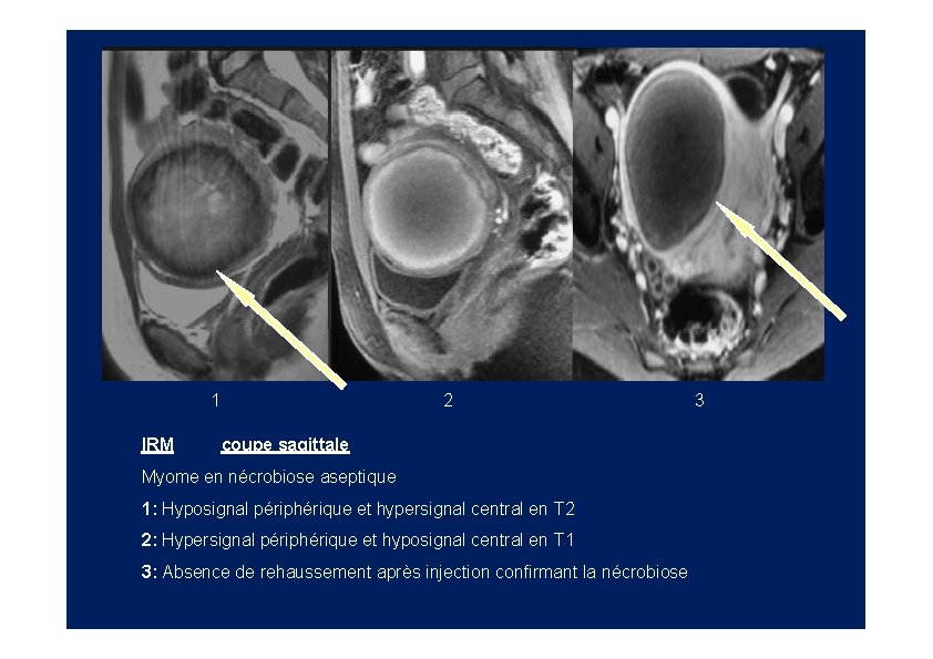 MYOMES UTERINS Present par Dr BICHA Introduction Tumeur