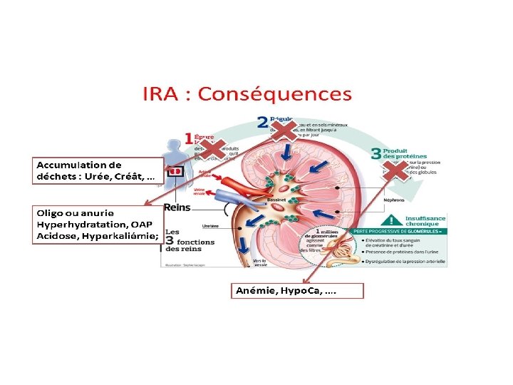 INSUFFISANCE RENALE AIGUE OBSTRUCTIVE Service durologie et de