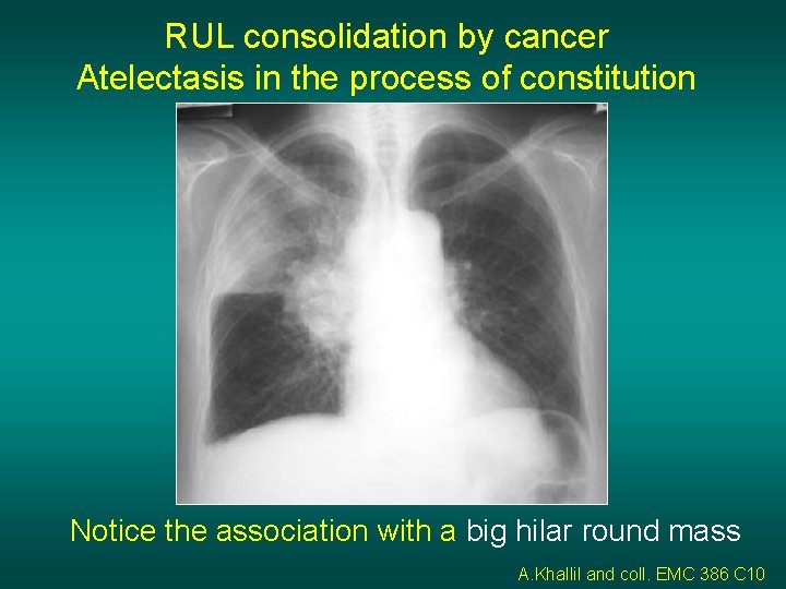 Bronchial syndrome Atelectasis Draining bronchus Bronchiectasis Etienne ...