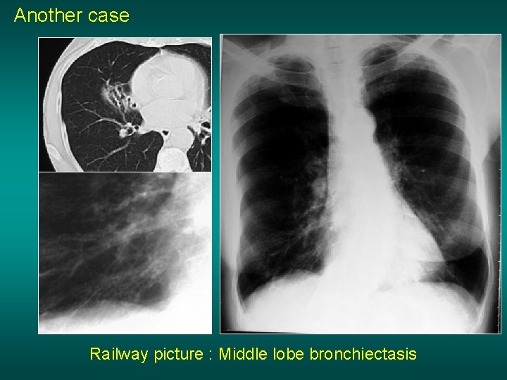 Bronchial syndrome Atelectasis Draining bronchus Bronchiectasis Etienne ...