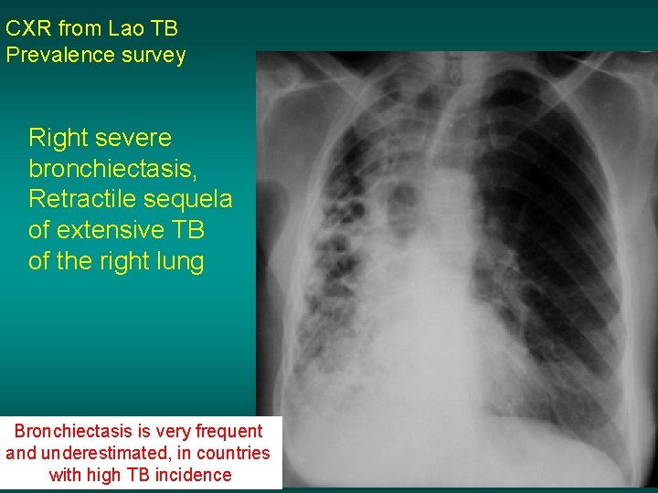 Bronchial syndrome Atelectasis Draining bronchus Bronchiectasis Etienne ...