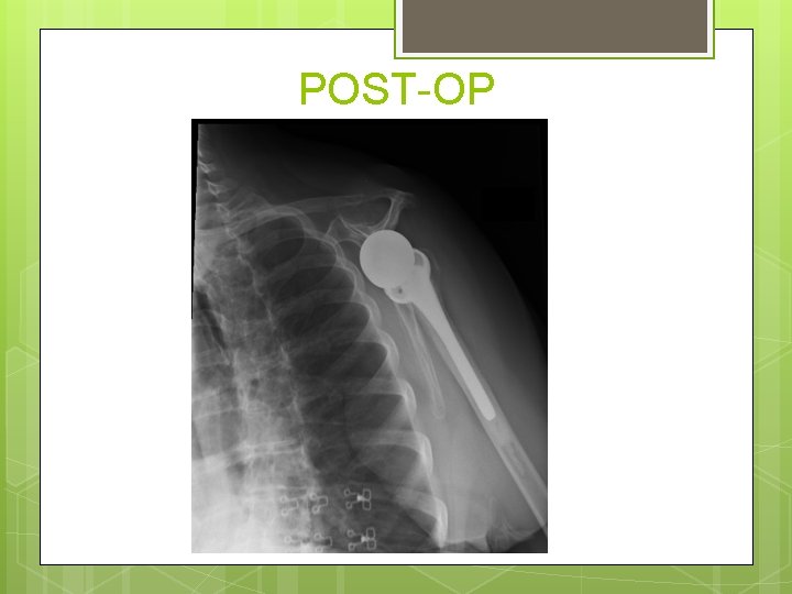 REVERSE TOTAL SHOULDER ARTHROPLAST Y Jonathan Samuelson WHY
