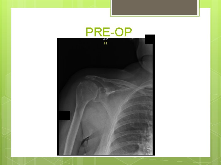 REVERSE TOTAL SHOULDER ARTHROPLAST Y Jonathan Samuelson WHY