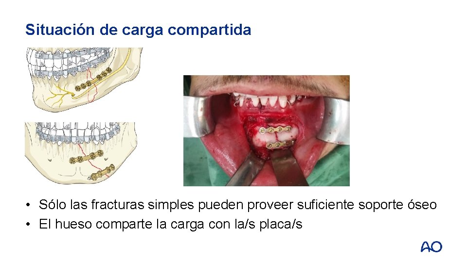 Fracturas mandibulares carga soportada y carga compartida Objetivos