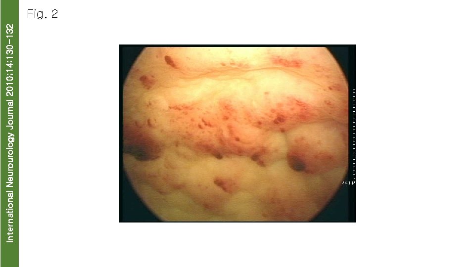 International Neurourology Journal 2010 14 130 132 A