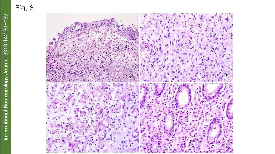 International Neurourology Journal 2010 14 130 132 A
