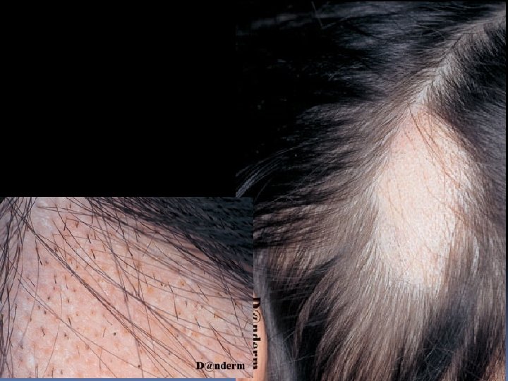 Objective Normal anatomy of hair follicle and hair