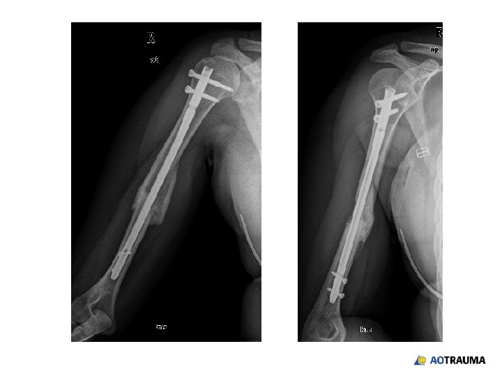 Polytrauma Case 2 AOTrauma Masters courseSDL Polytrauma course