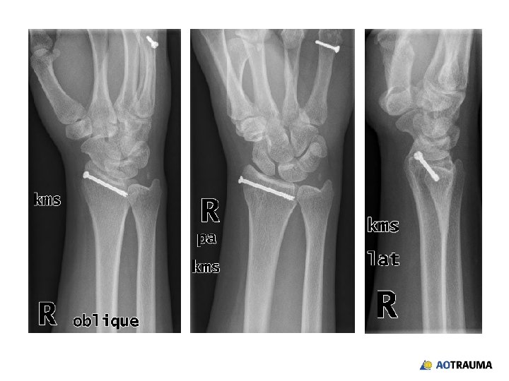 Polytrauma Case 2 AOTrauma Masters courseSDL Polytrauma course