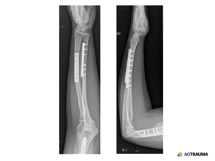 Polytrauma Case 2 AOTrauma Masters courseSDL Polytrauma course