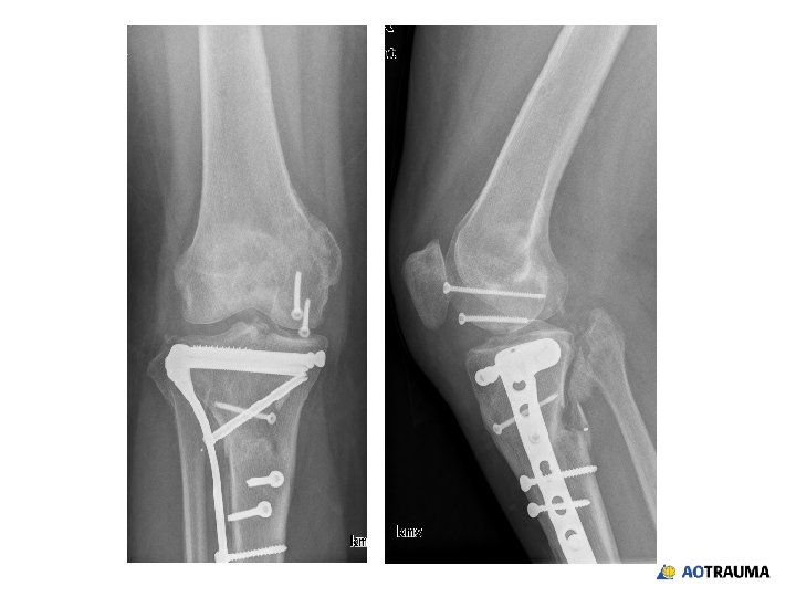 Polytrauma Case 2 AOTrauma Masters courseSDL Polytrauma course