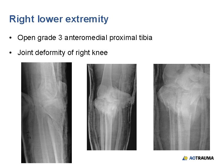 Polytrauma Case 2 AOTrauma Masters courseSDL Polytrauma course