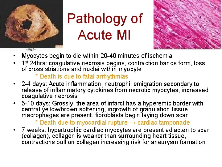 AOA Cardiology Review Part 1 Myocardial Infarction Objectives