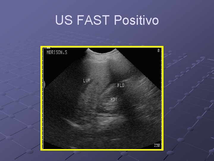 Trauma Abdominal Un Enfoque Prehospitalario para el TEM