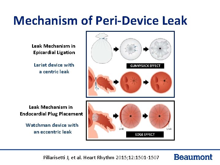 Assessment and Management of Residual Leaks after LAA
