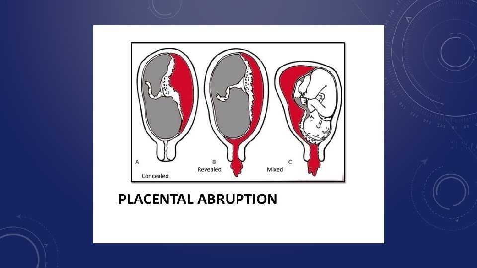 SARAH AWAISHEH ANTEPARTUM HEMORRHAGE ANATOMY OF THE UTERUS