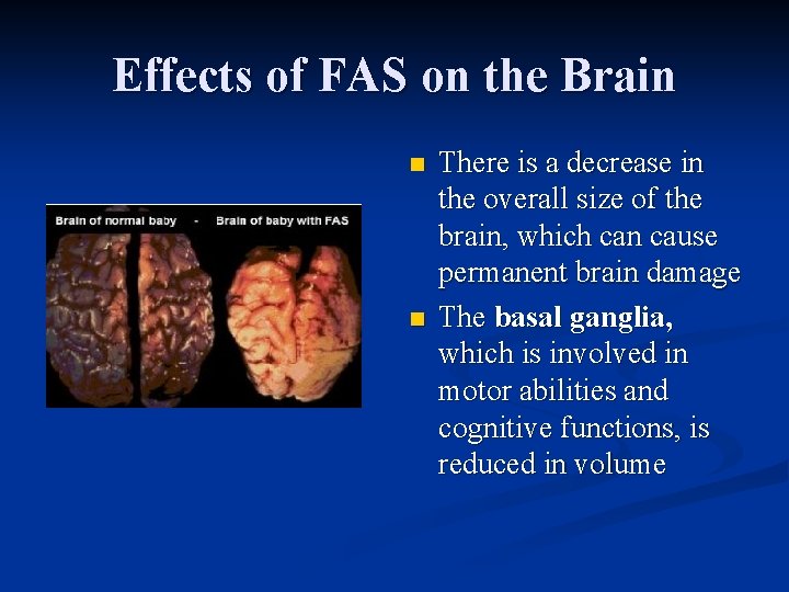 Fetal Alcohol Syndrome Presented by Amy Pearce Allison