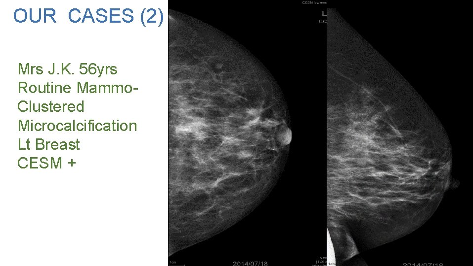 ContrastEnhanced Spectral Mammography CESM An Overview ContrastEnhanced ...