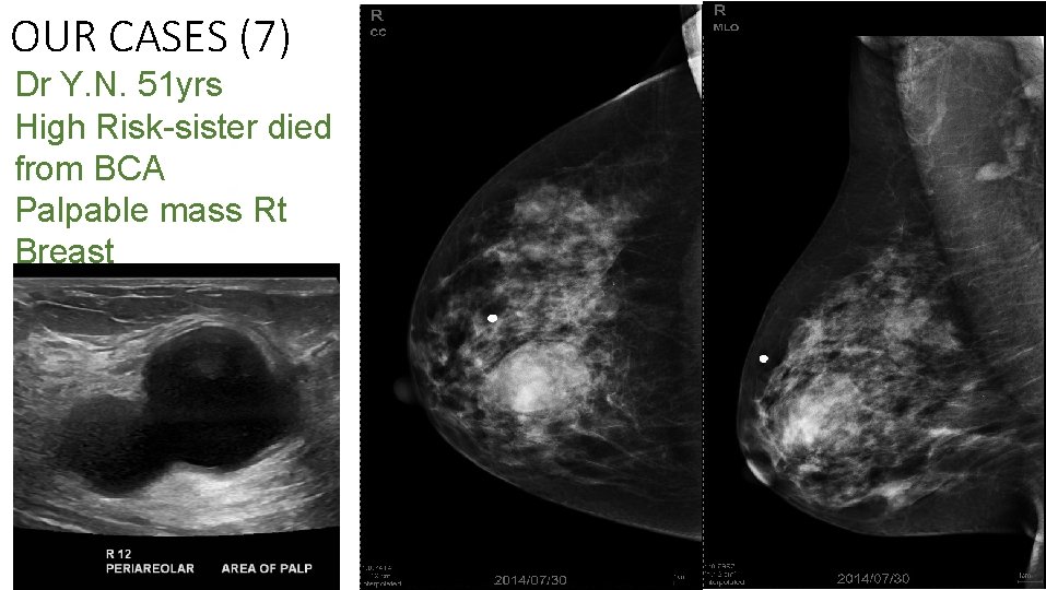 ContrastEnhanced Spectral Mammography CESM An Overview ContrastEnhanced ...
