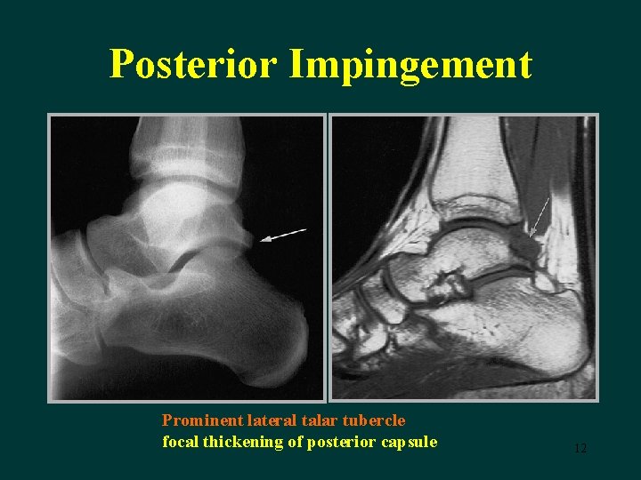 Ankle Impingement Syndrome initial ankle injury abnormal osseous