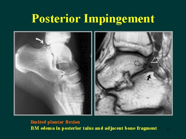 Ankle Impingement Syndrome initial ankle injury abnormal osseous